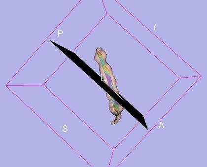 Modules:Model Into Label Volume Documentation-3.6 - Slicer Wiki