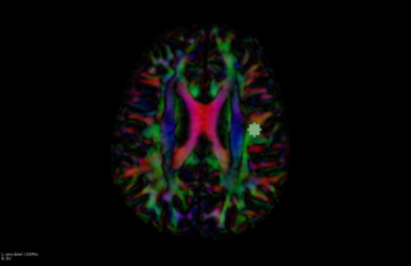 Documentation/Nightly/Extensions/DTI ALPS - Slicer Wiki