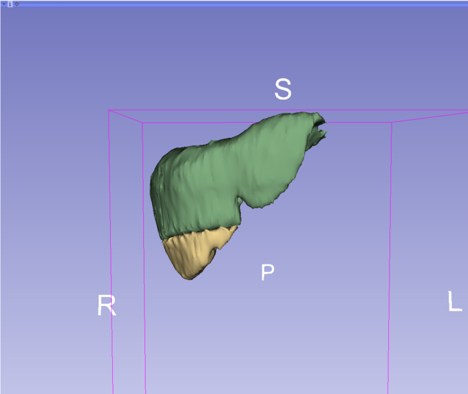 Documentation/4.4/Modules/ResectionVolume - Slicer Wiki