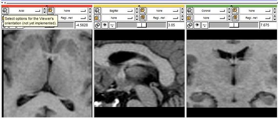 Slicer3:Module:Target Preprocessing-Documentation-3.2 - Slicer Wiki