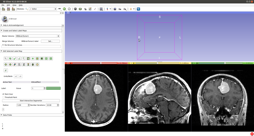 Documentation/4.10/Modules/CarreraSliceInteractiveSegmenter - Slicer Wiki