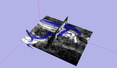 Modules:VMTKLevelSetSegmentation - Slicer Wiki