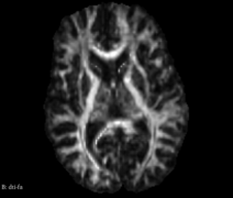 Documentation/Nightly/Extensions/DiffusionComplexityMap - Slicer Wiki
