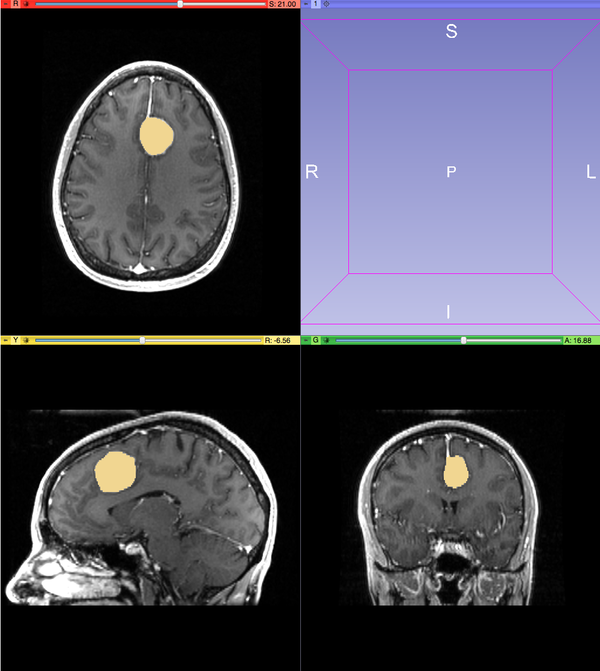 Documentation/4.4/Modules/Editor/WatershedFromMarkers - Slicer Wiki