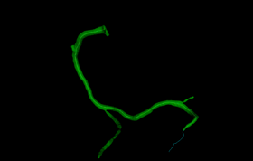 Modules:VMTK in 3D Slicer Tutorial: Coronary Artery Centerline Extraction - Slicer Wiki