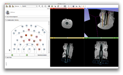 Documentation/Nightly/Extensions/iGyne - Slicer Wiki