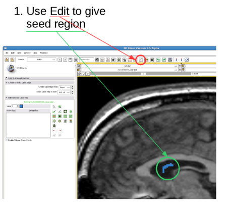 Modules:RobustStatisticsSeg-Documentation-3.6 - Slicer Wiki