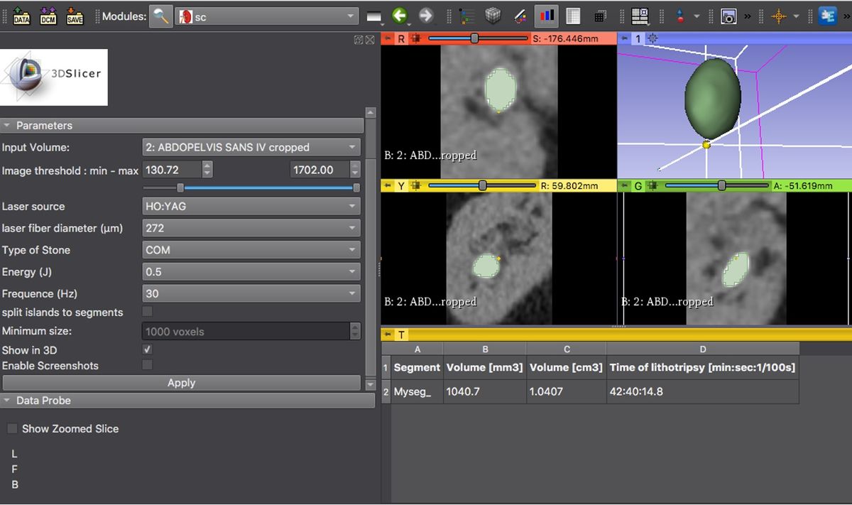 Documentation/Nightly/Modules/KidneyStoneCalculator - Slicer Wiki