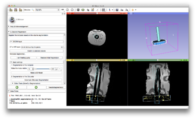 Documentation/Nightly/Extensions/iGyne - Slicer Wiki