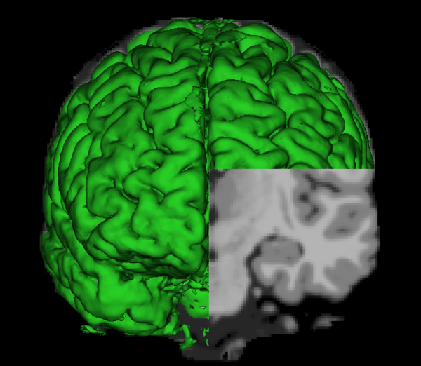 Documentation/4.10/Modules/BrainLogisticSegmentation - Slicer Wiki