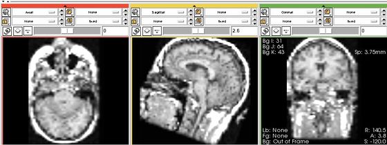 Modules:ThresholdImage-Documentation-3.6 - Slicer Wiki