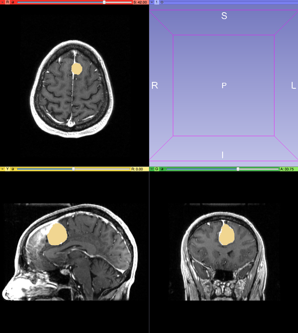 Documentation/4.10/Modules/Editor/WatershedFromMarkers - Slicer Wiki