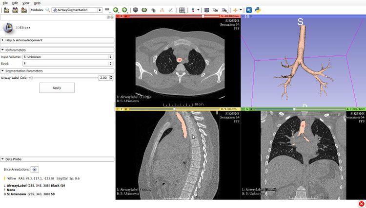 Documentation/4.6/Modules/AirwaySegmentation - Slicer Wiki
