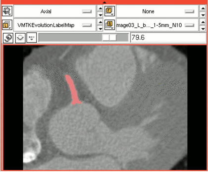 Modules:VMTK in 3D Slicer Tutorial: Coronary Artery Centerline Extraction - Slicer Wiki