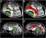 Documentation/Nightly/Modules/UKFTractography - Slicer Wiki