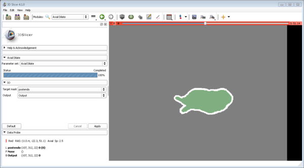 Documentation/Nightly/Modules/SlicerModuleAxialDilate - Slicer Wiki