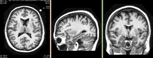 Documentation/4.5/Modules/SkullStripper - Slicer Wiki