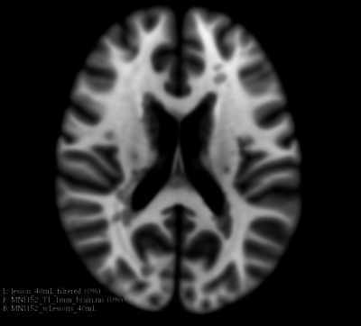 Documentation/Nightly/Modules/MSLesionSimulator - Slicer Wiki