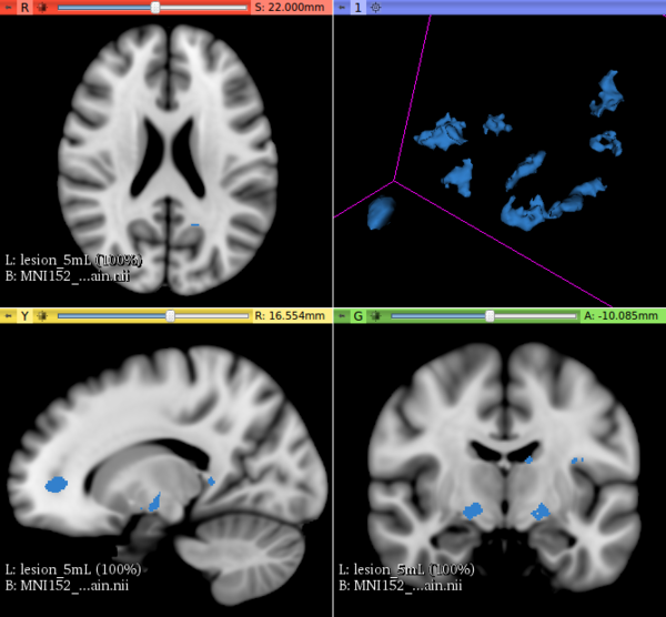 Documentation/Nightly/Extensions/LesionSimulator - Slicer Wiki