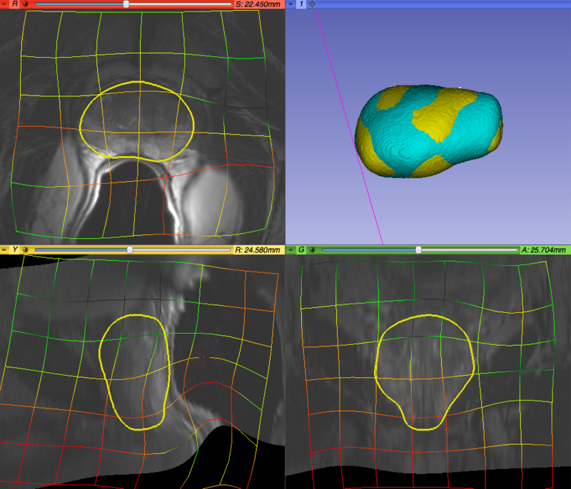 Documentation/4.8/Modules/DistanceMapBasedRegistration - Slicer Wiki